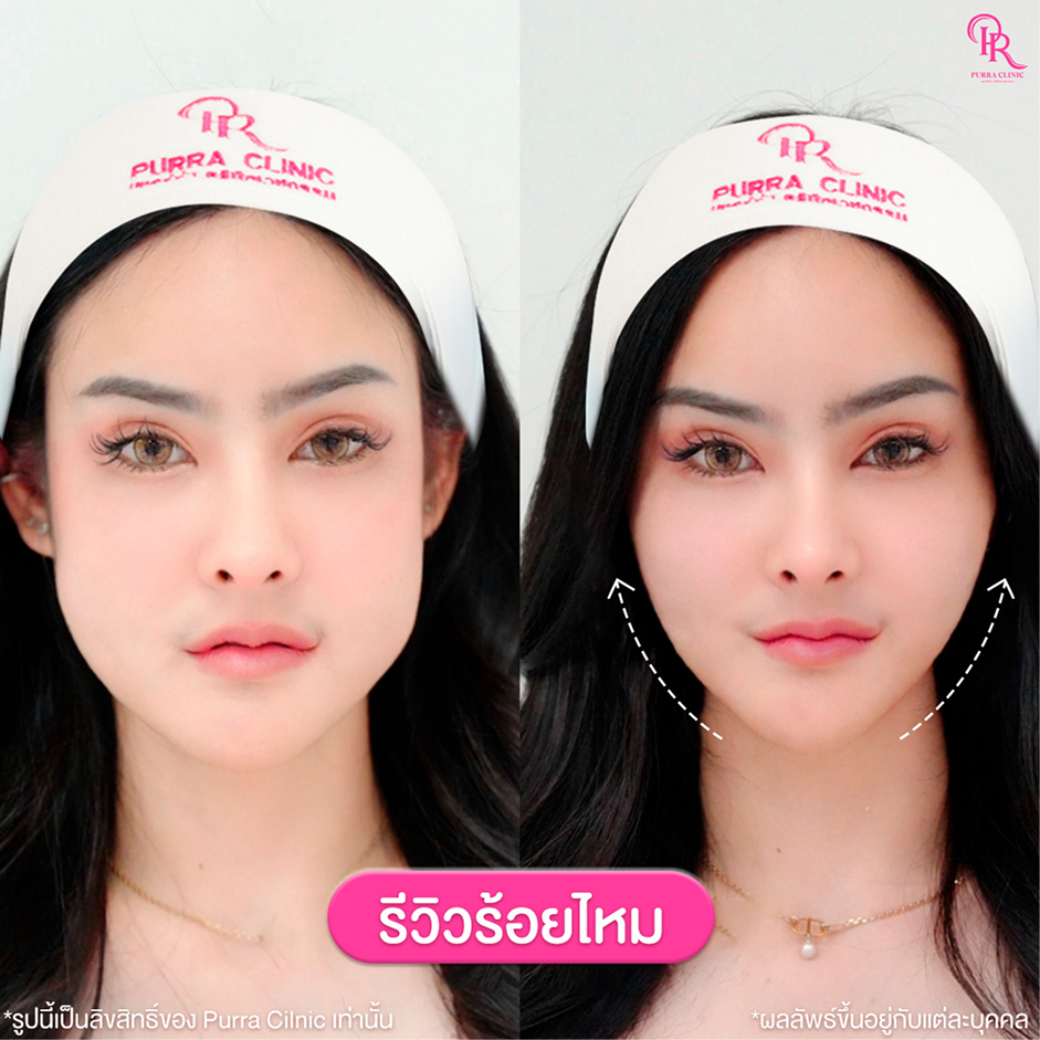 เพอร์ร่าคลินิก (Purra Clinic) ตอบโจทย์ทุกความต้องการด้านความงาม - Purra ...