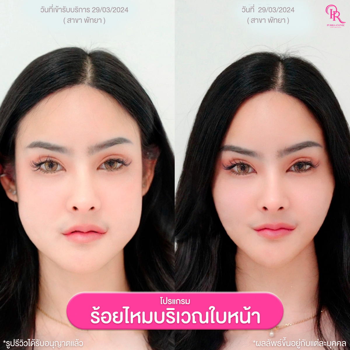 ร้อยไหม - Purra Clinic