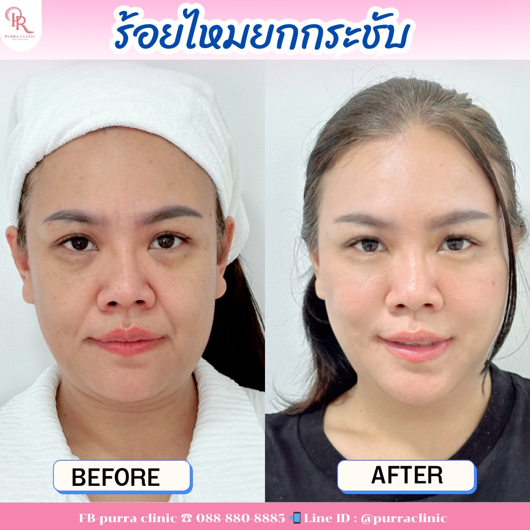 Thread Lift - Purra Clinic