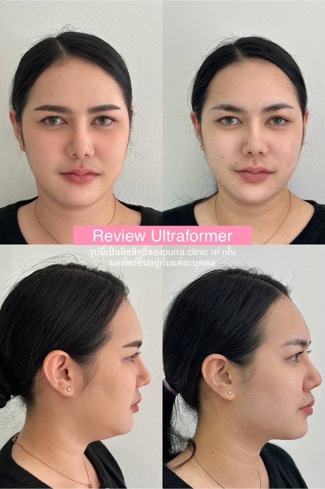 Ultraformer - Purra Clinic